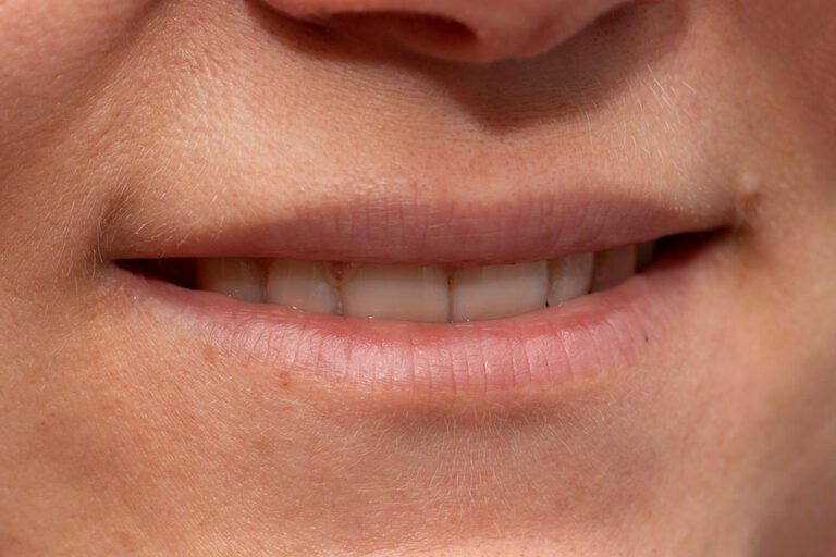 Make Your Lips Bigger With Clinical Lip Plumping in the Denver Area