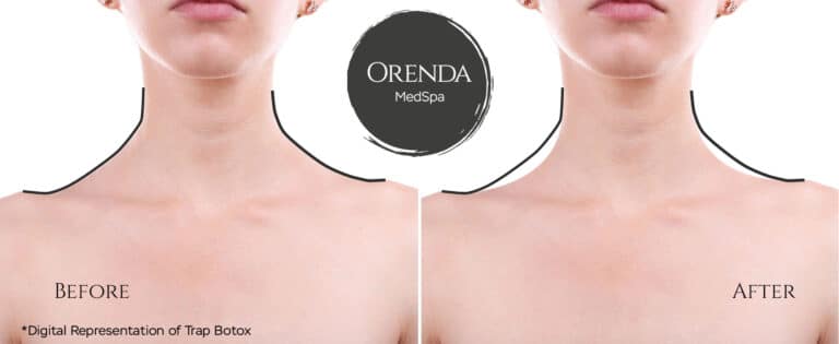 Barbie Botox, Otherwise Known As Trap Botox - Orenda Med Spa